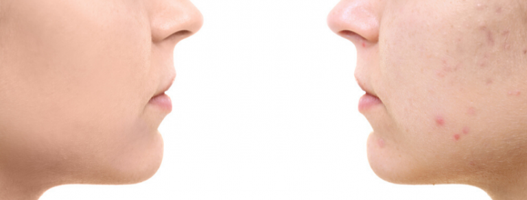 Marijuana And Your Skin: The Effect - Togo Weed